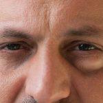 Tengo el párpado superior hinchado. ¿Puede ser un orzuelo? | Blog de ...