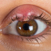 Ojos hinchados: un síntoma de alergia